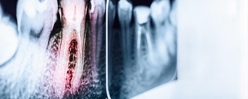 What is Endodontic Treatment? – My Dental Practice Website
